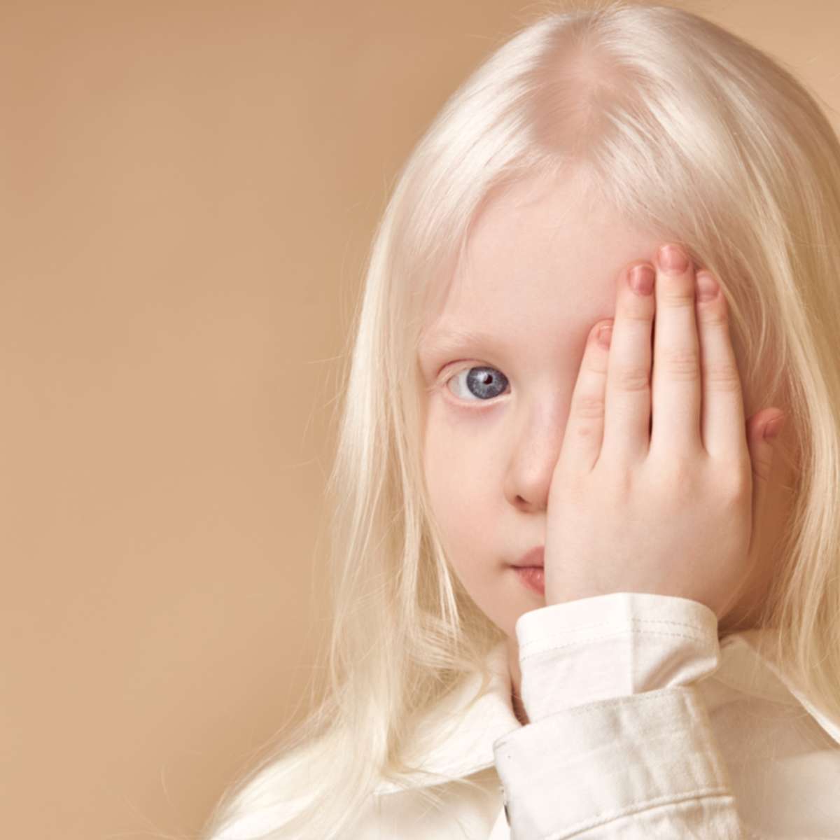 Pessoas Albinas Com Olhos Vermelhos ALBINISMO: O QUE É COMO CUIDAR DA