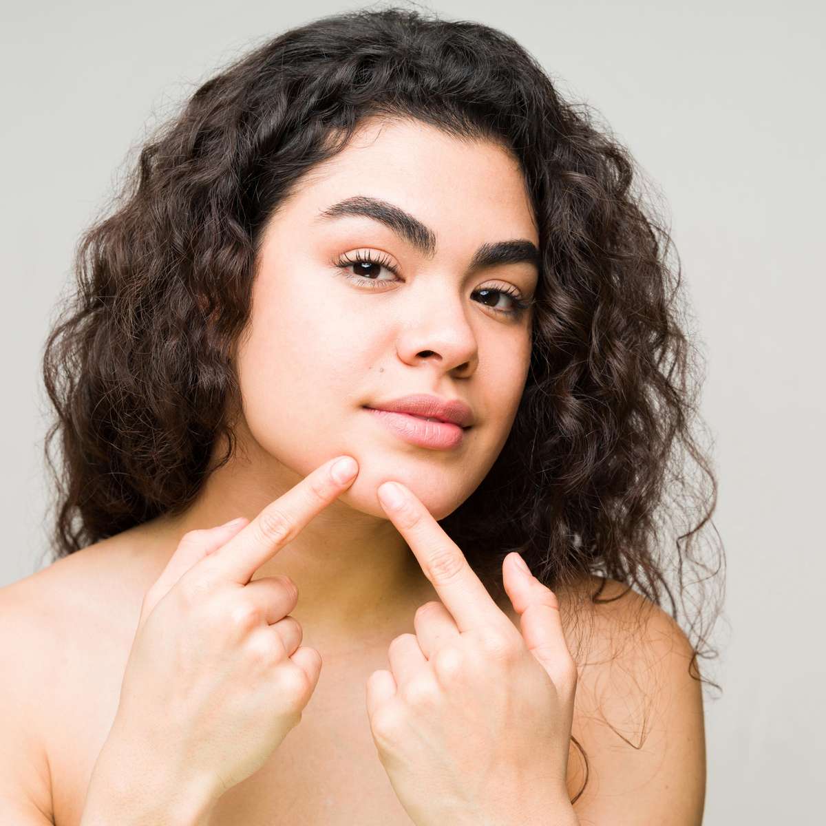 Como Se Livrar De Cicatrizes De Acne Cicatriz De Acne Dra Pamela