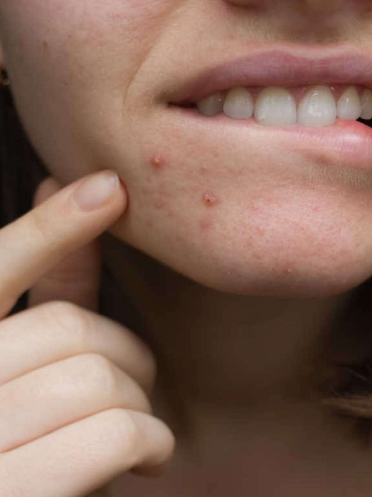 Erupcao Cutanea Por Deficiencia De Vitamina B12 Manifestações