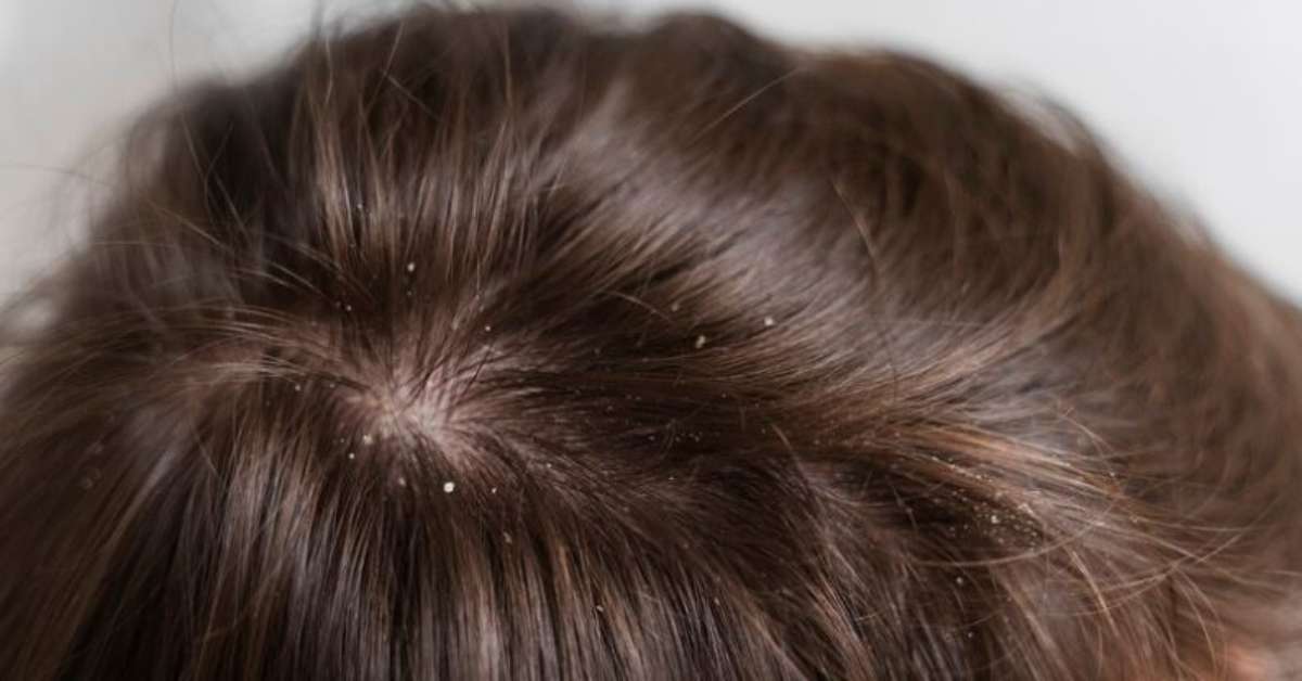 Dicas para se livrar da caspa e acabar com o constrangimento