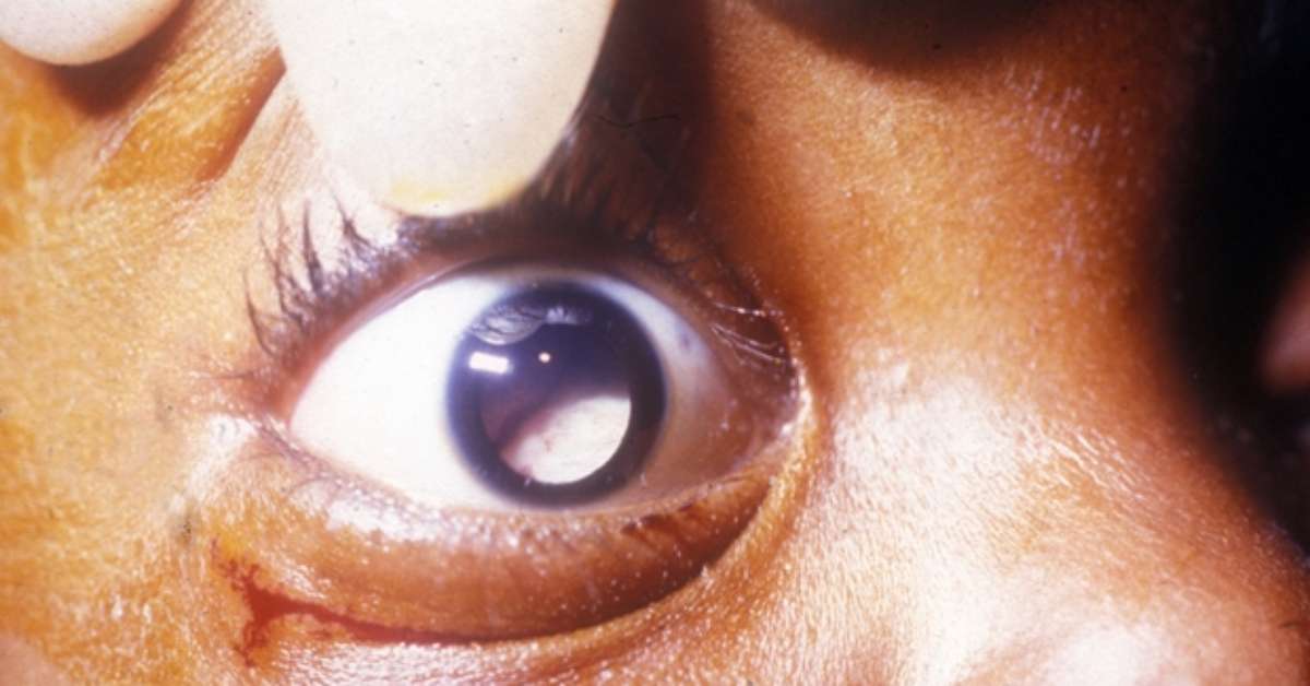 Câncer nos olhos pode levar à cegueira e até à morte