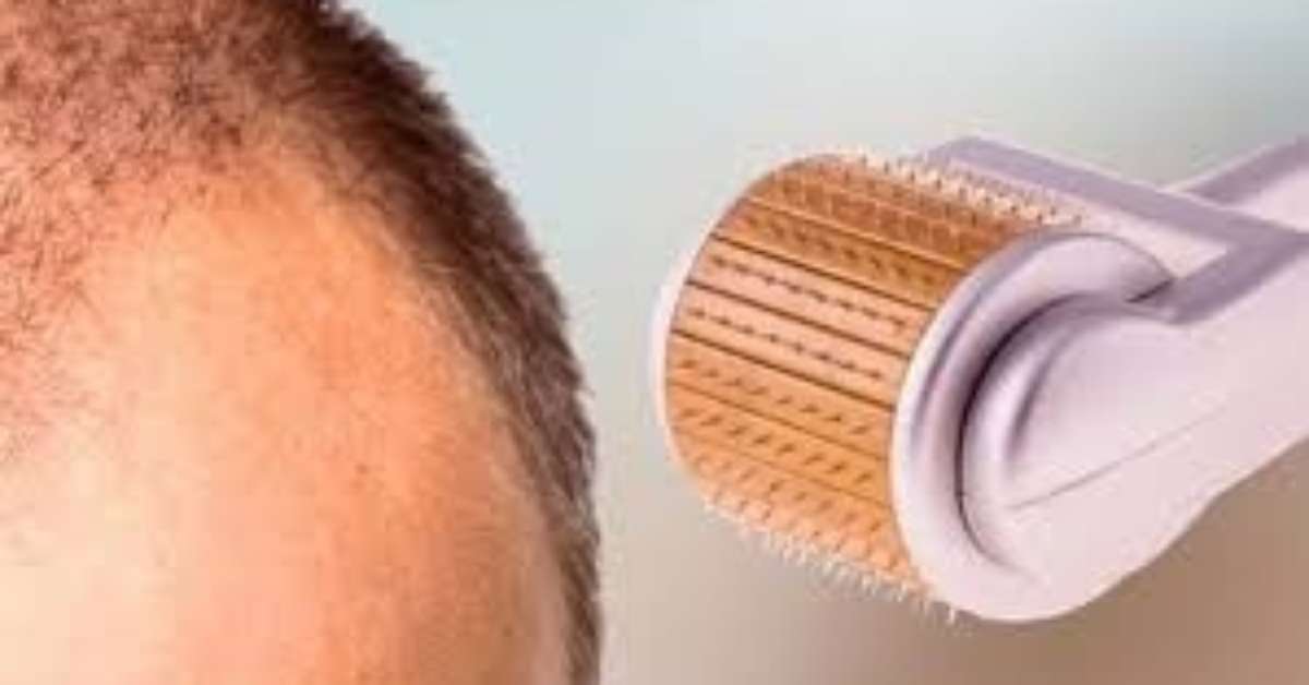 Microagulhamento capilar pode ajudar na queda de cabelo