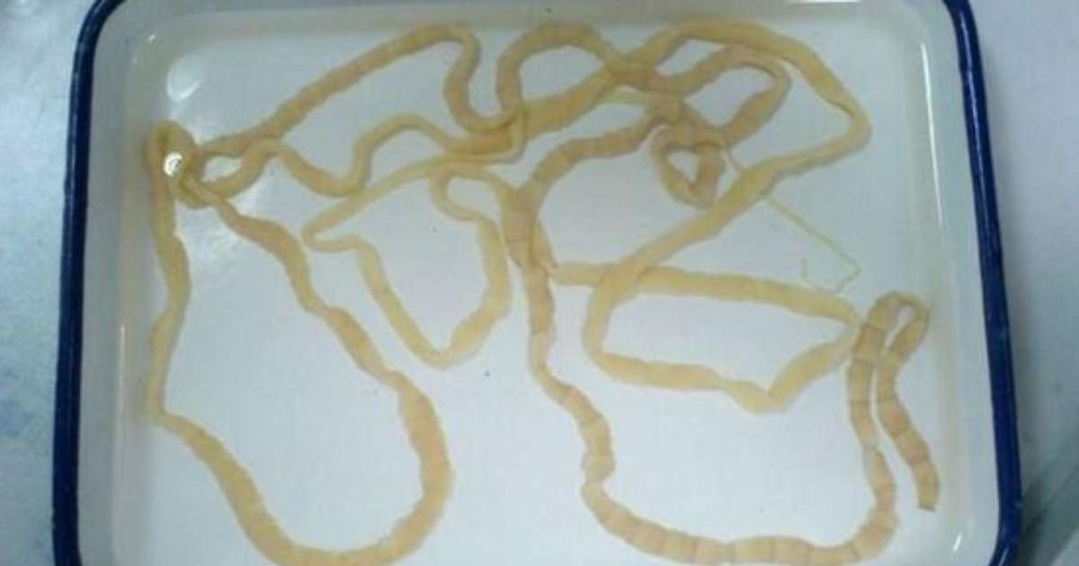 Verme de 2 metros é removido de chinesa que comeu carne crua