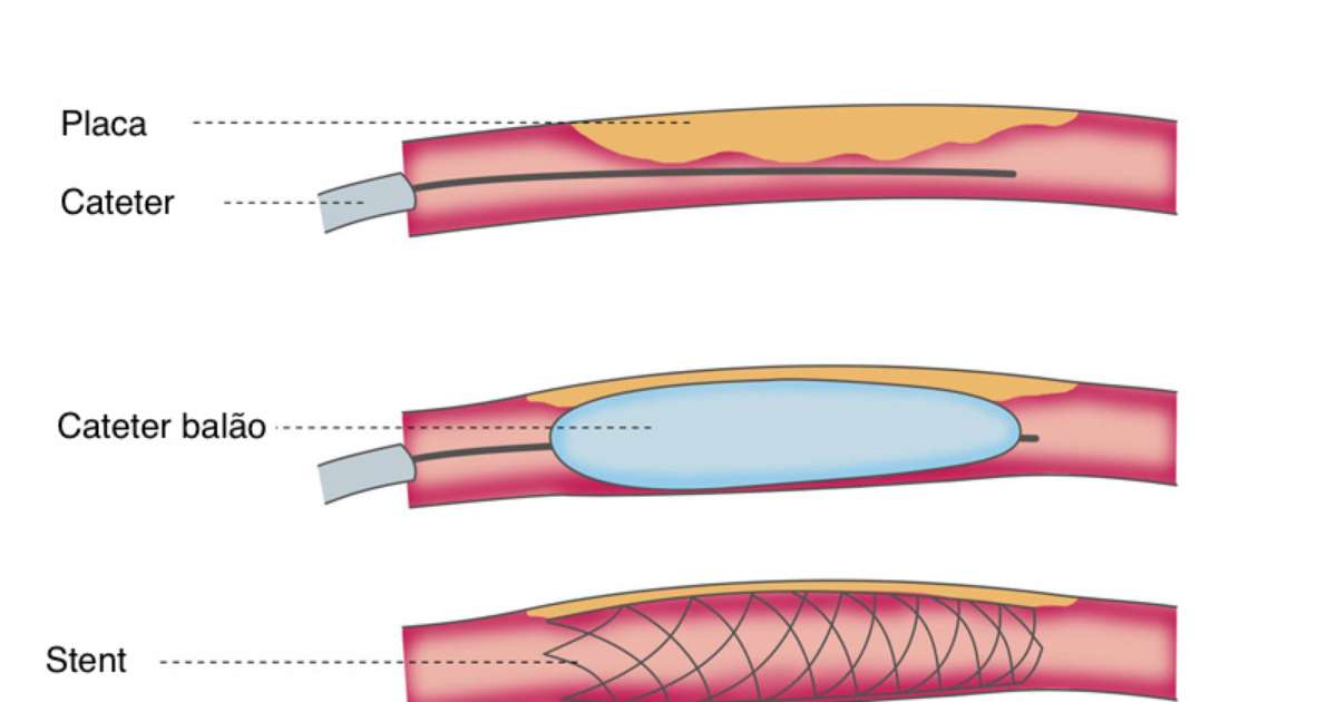 Radiologia Intervencionista: tire suas dúvidas sobre Angioplastia e ...