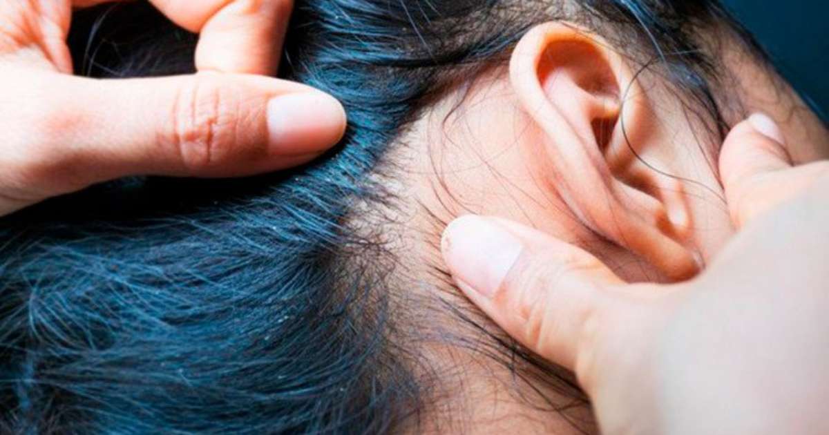 Especialista ensina a prevenir e combater o piolho