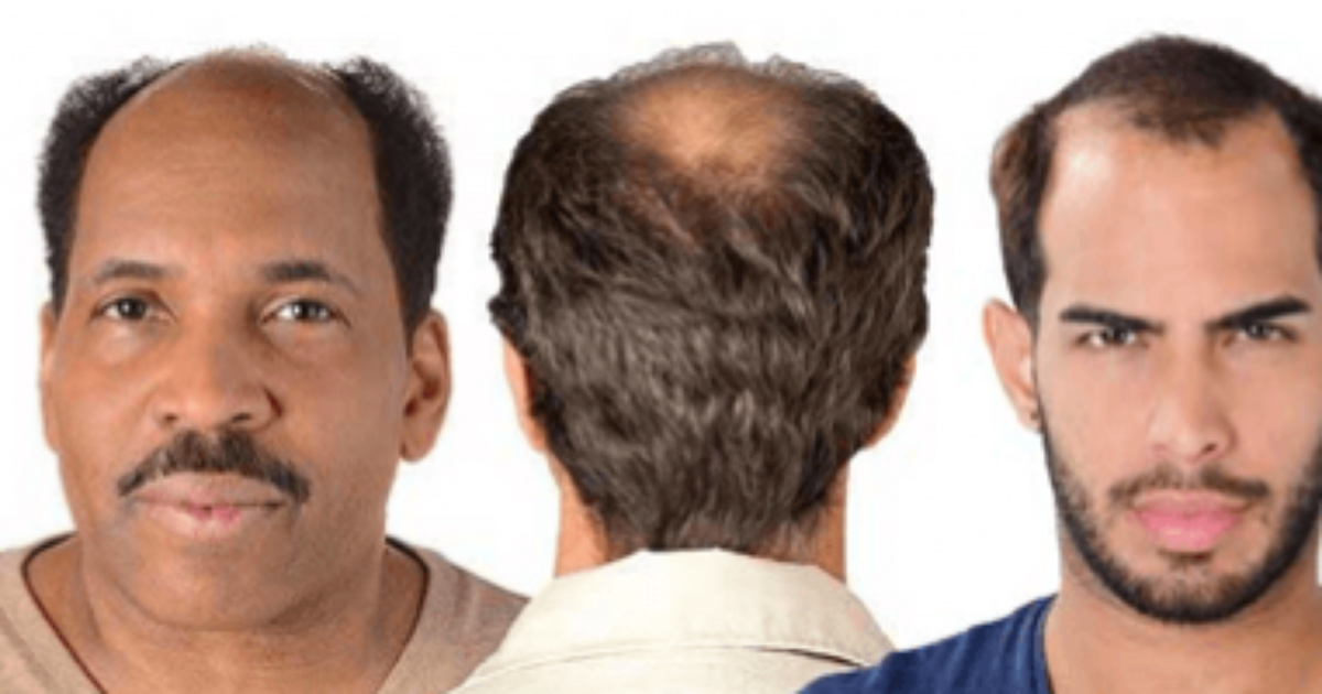 Segundo dados, cerca de 42 milhões de brasileiros sofrem com a calvície