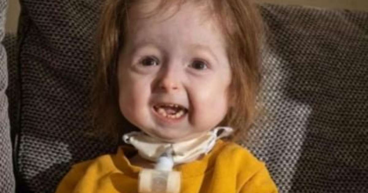 Bebê é única no mundo a possuir doença de Benjamin Button