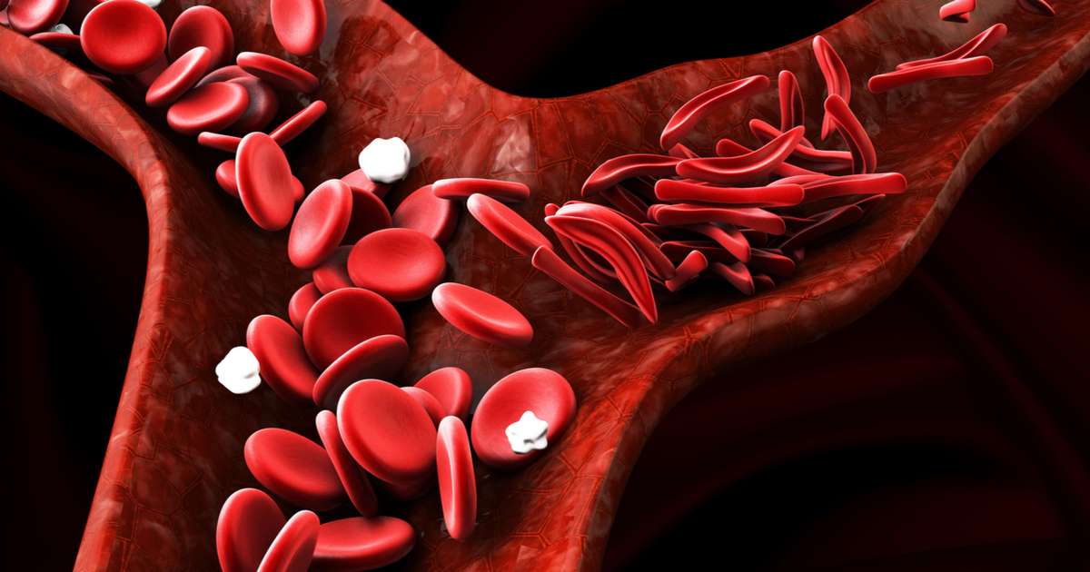 Conheça os sintomas e o tratamento da doença falciforme