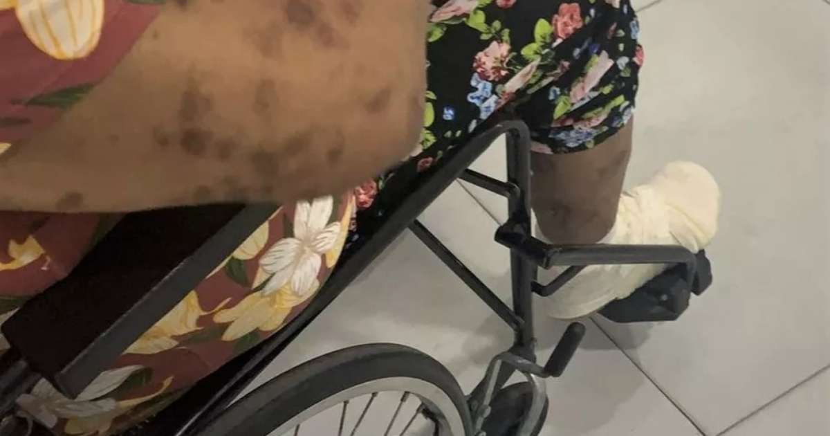 Perna de paciente necrosa e será amputada após demora em atendimento