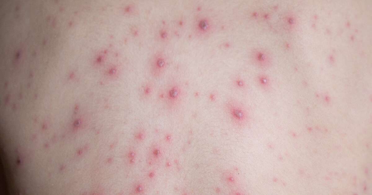 Quais são os sintomas da varíola dos macacos? Entenda a doença