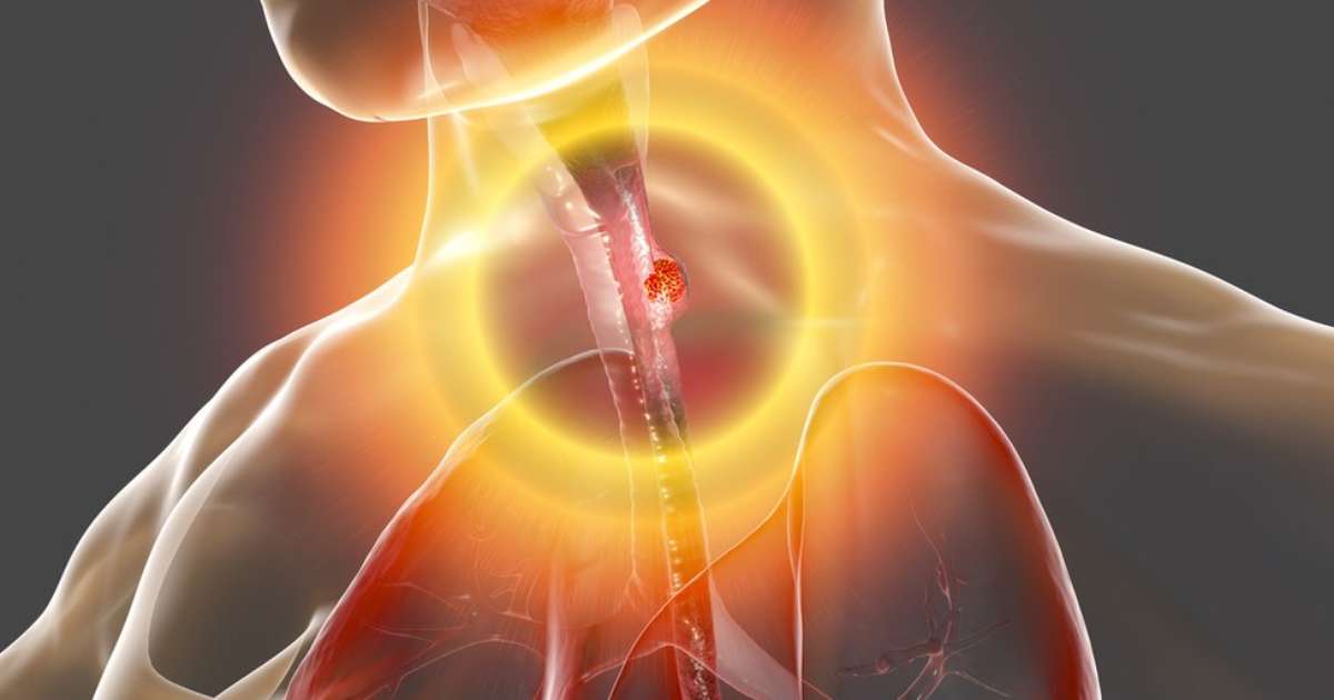 Os sintomas de câncer no esôfago que não devemos ignorar