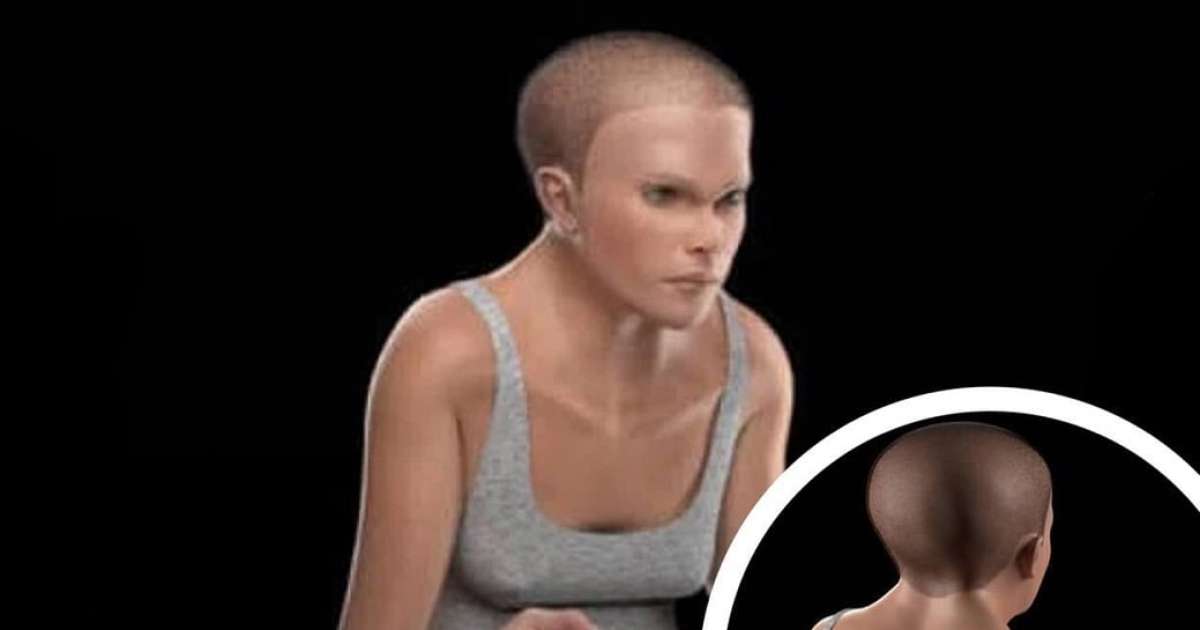 'Humano do futuro' tem corpo curvado e aparência espantosa; médicos dão ...