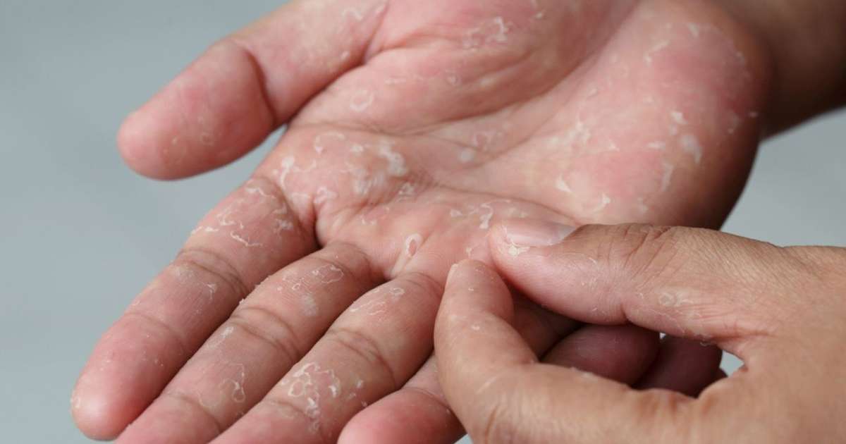 Bolhas nos pés e nas mãos pode ser disidrose; conheça problema