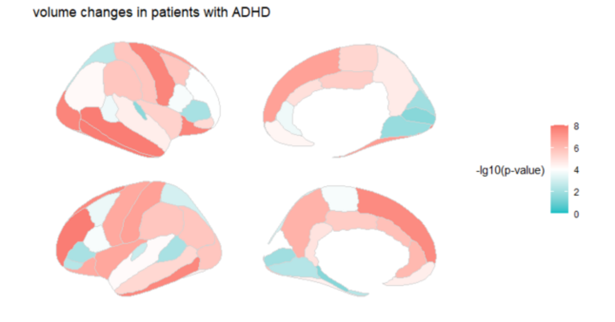 Cientistas descobrem como identificar TDAH no cérebro de crianças