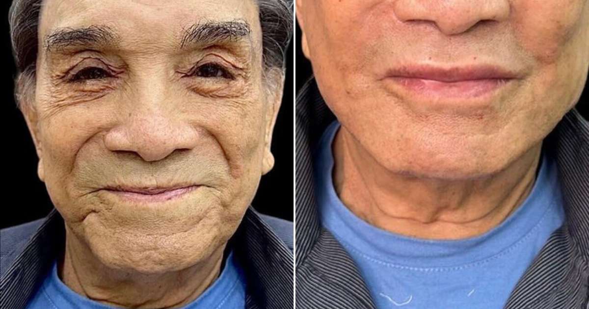 Dedé Santana diz que se assustou com resultado de harmonização facial