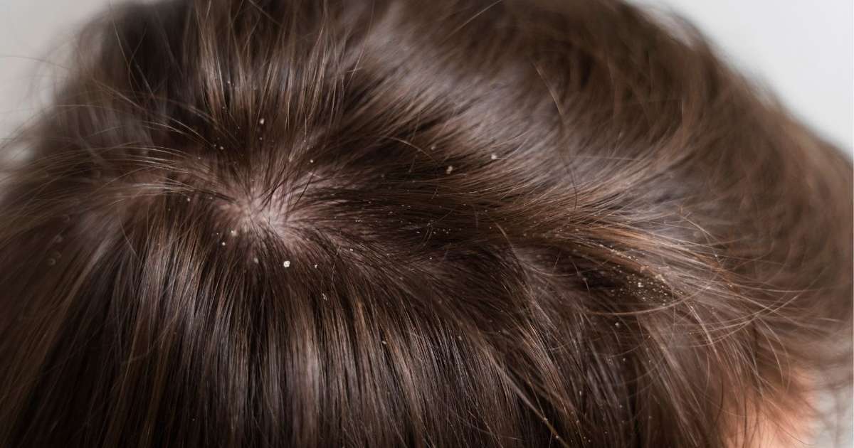 Caspas: o que causam e como tratar? Dermatologista explica