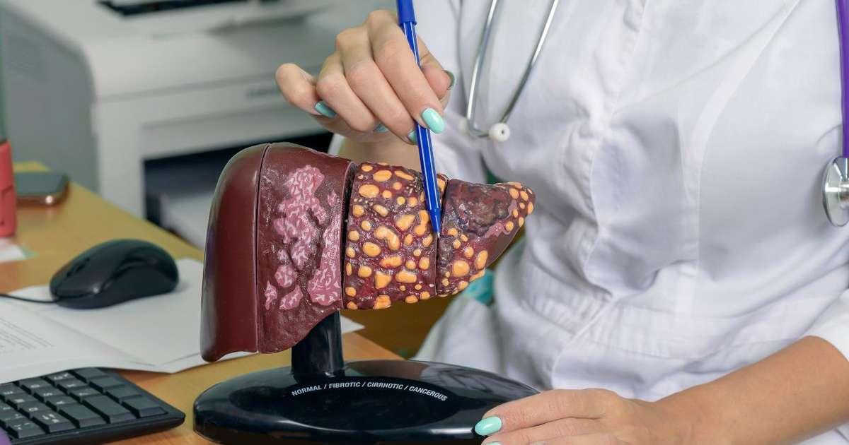 Esteatose hepática: saiba como evitar o acúmulo de gordura no fígado