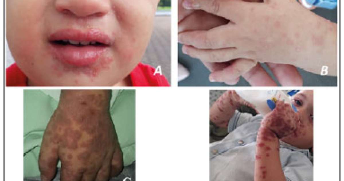 Síndrome mão-pé-boca: saiba as causas, os tratamentos e os riscos da doença