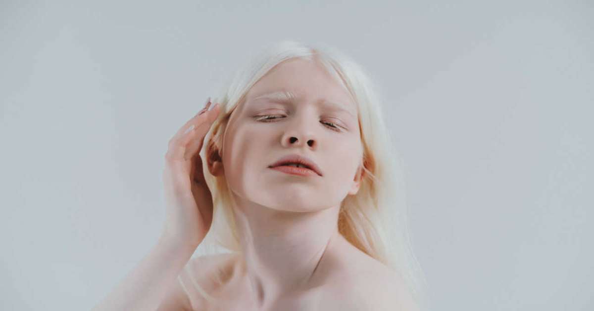 Dia do Albinismo: quais os cuidados necessários com a pele albina?