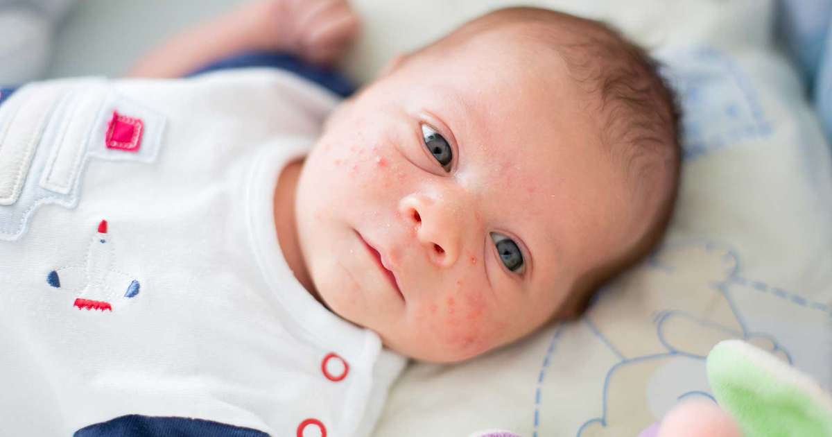 Brotoeja em bebê e criança: por que ela aparece e como tratar