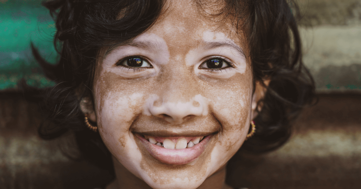 Dia Mundial do Vitiligo: entenda como é caracterizada essa doença