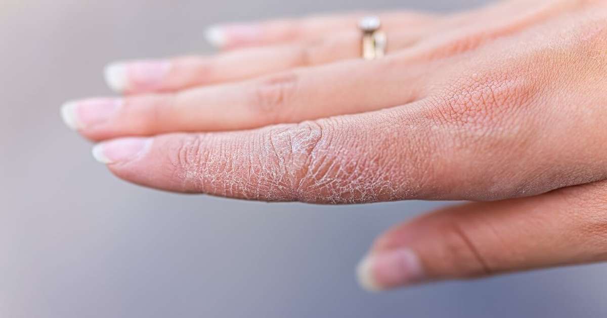 Dermatologista explica o que pode causar a disidrose