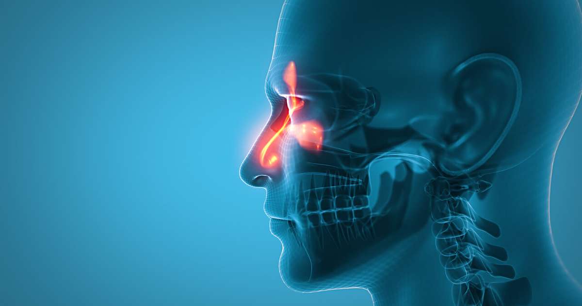 Sinusite pode matar: veja quais os sinais de agravamento da doença