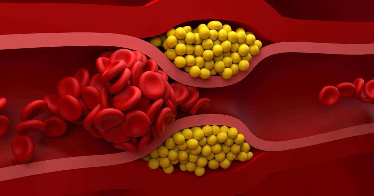 Dia de Combate ao Colesterol: a importância do exercício