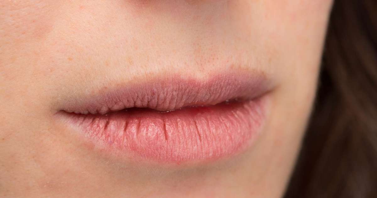 Lábios rachados: 4 dicas que ajudam a resolver o problema