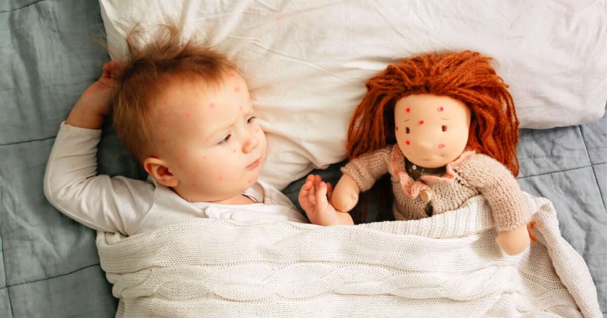 Catapora: conheça os sintomas e saiba como prevenir essa doença