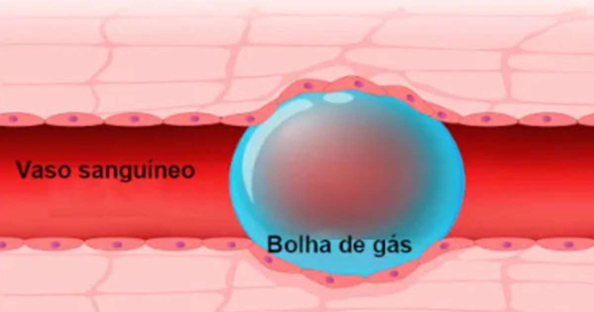 O que estudar sobre embolia gasosa