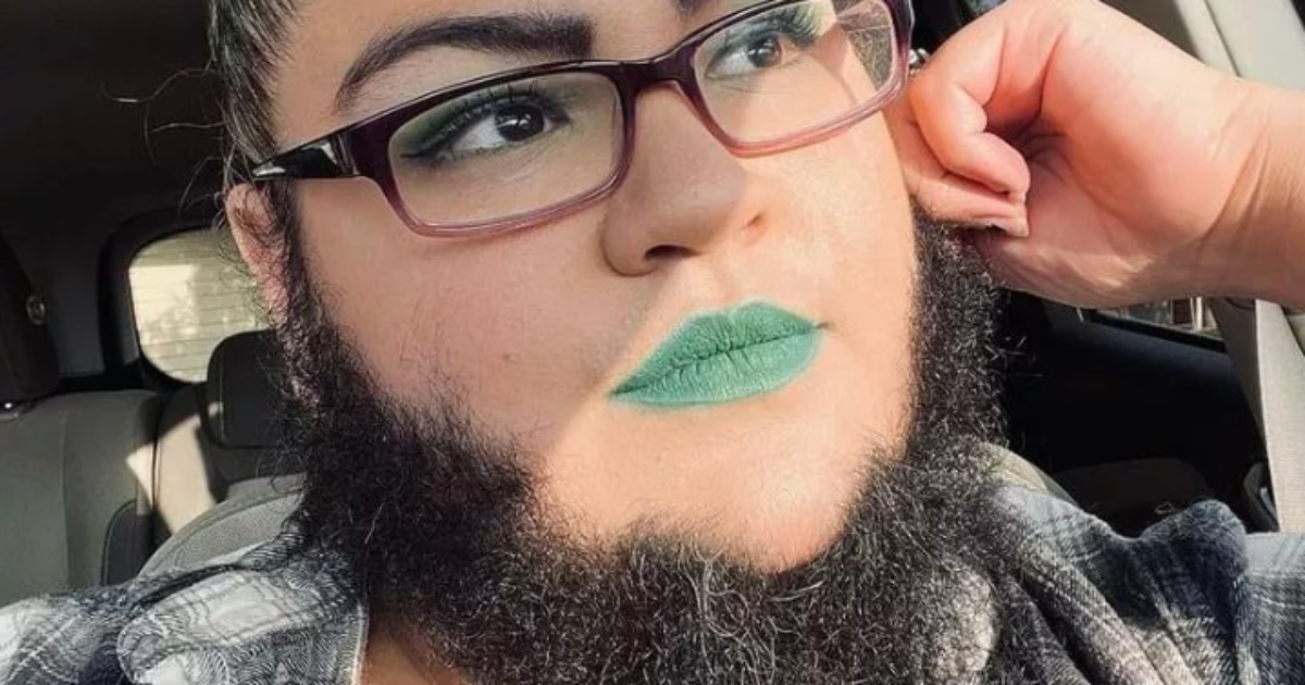Mulher assume barba após 2 décadas sofrendo com Síndrome do Ovário ...