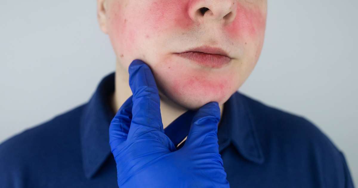 7 razões comuns para vermelhidão no rosto