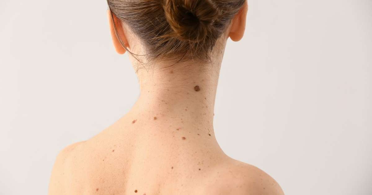 Pintas na pele: saiba quando elas oferecem riscos à saúde