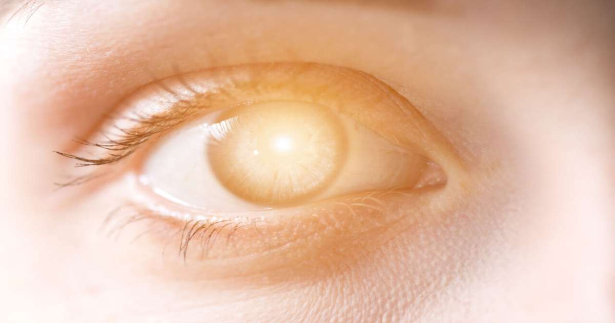 Fotofobia: olhos ficam mais sensíveis nesta época do ano