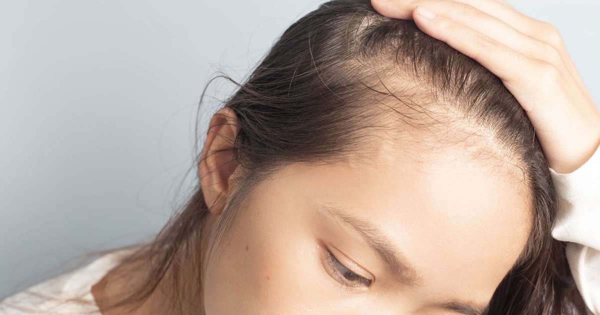 Calvície feminina: conheça os tipos e como tratar a condição