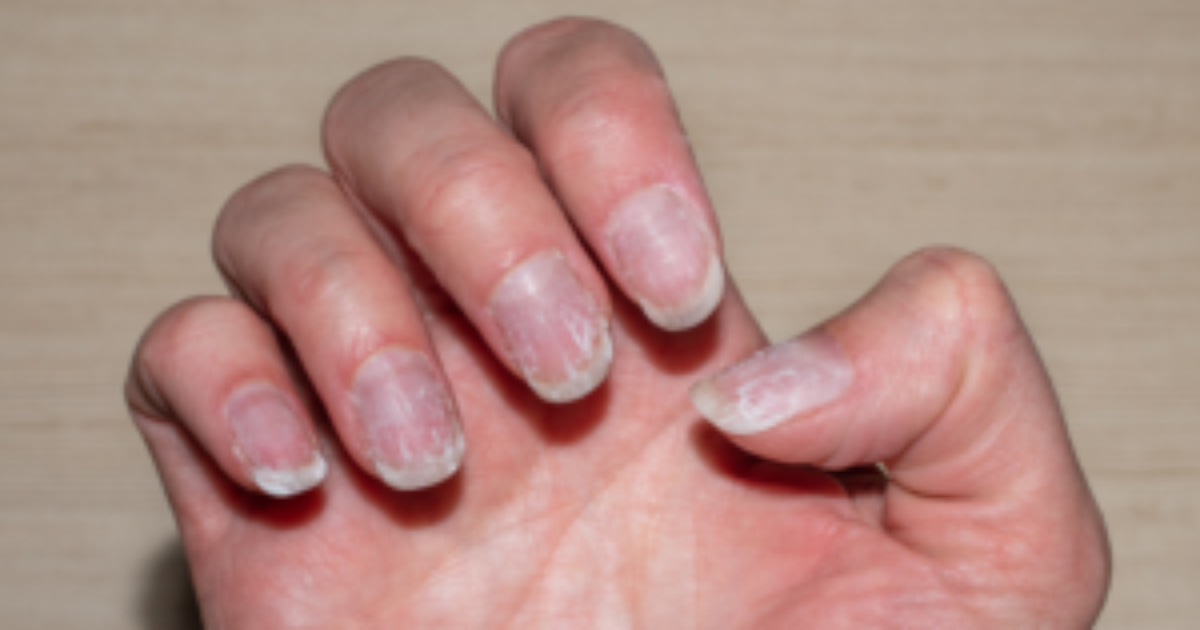 Descubra o segredo para acabar com as unhas fracas e quebradiças
