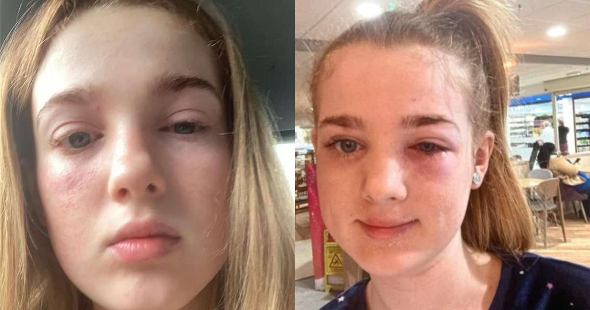 Menina de 13 anos quase fica cega por dica de beleza que viu no TikTok