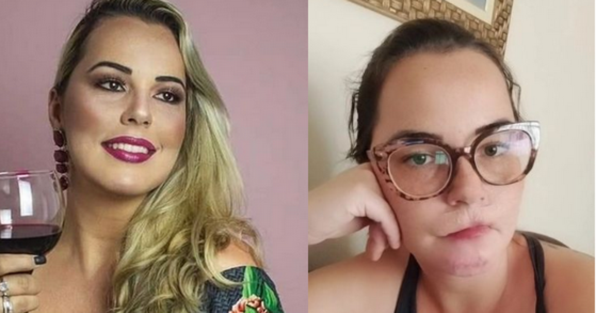 Influenciadora perde lábio após harmonização facial com PMMA: "Só ...