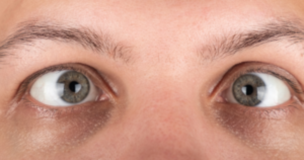 Estrabismo: entenda a condição e a importância do diagnóstico ainda na ...