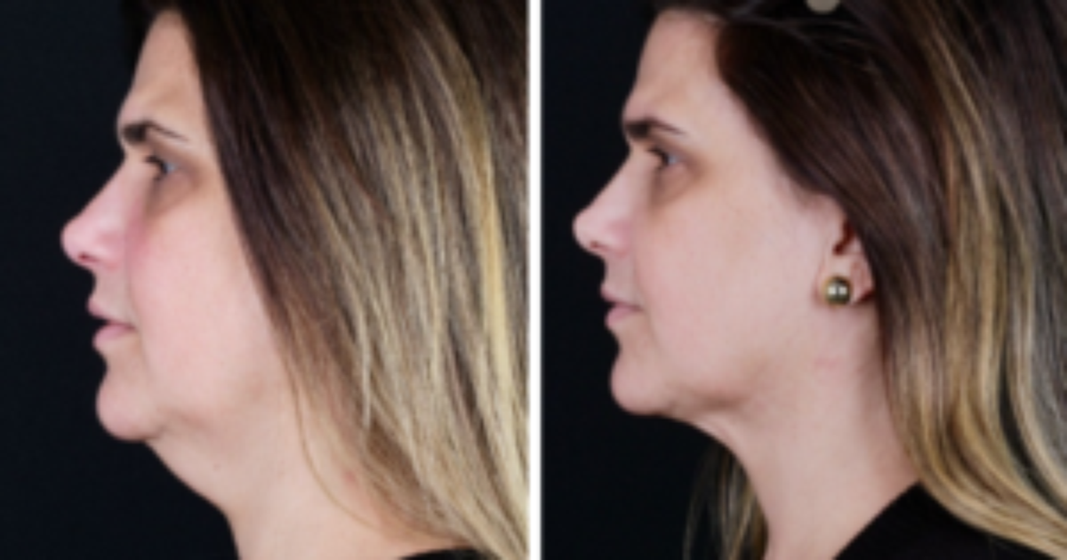Lipo de papada: o que é e quais as indicações