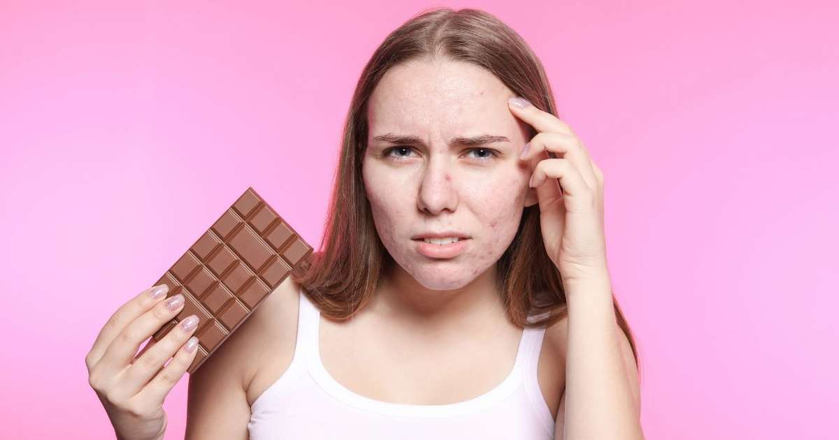 Chocolate causa acne? Saiba a verdade por trás dessa dúvida