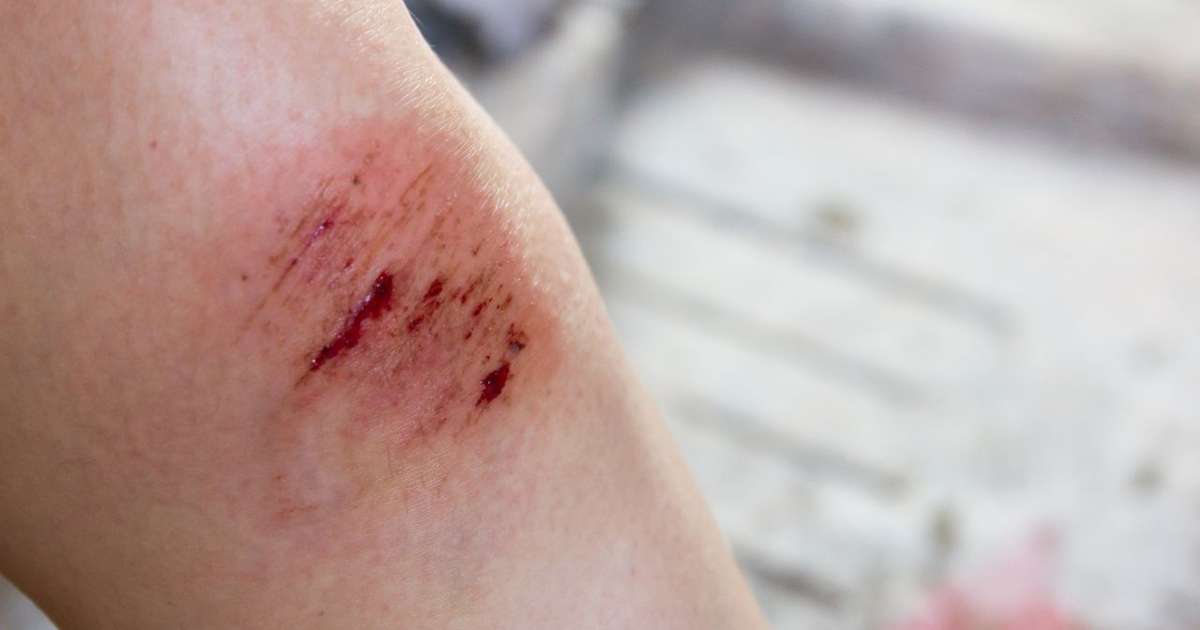 Ferida inflamada: saiba como tratar a condição