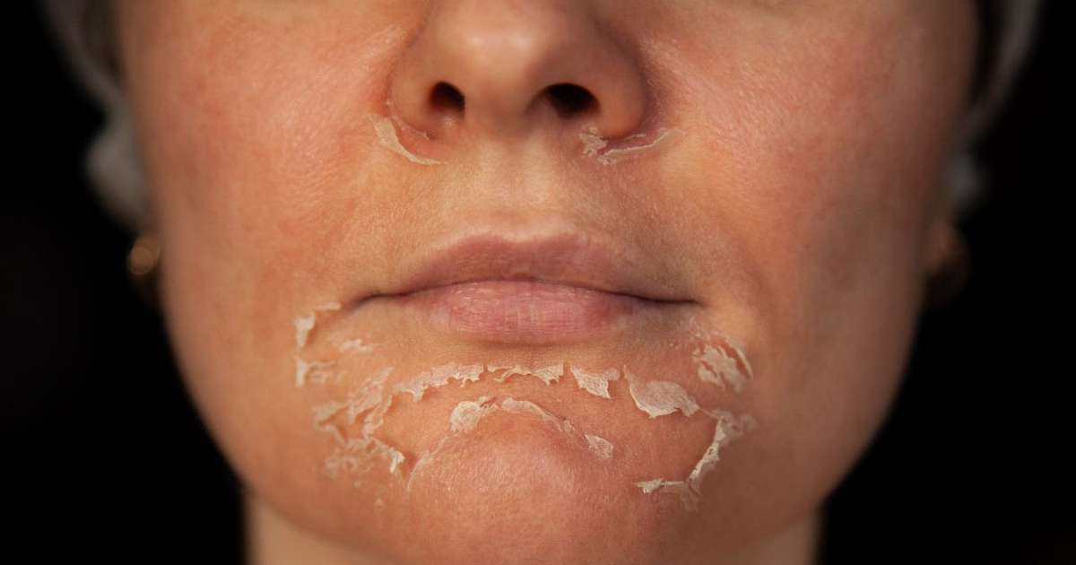 Peeling de fenol: que cuidados devemos ter ao fazer o procedimento ...