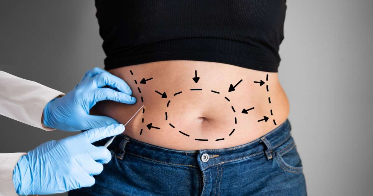 Cirurgião plástico responde 5 dúvidas sobre a abdominoplastia