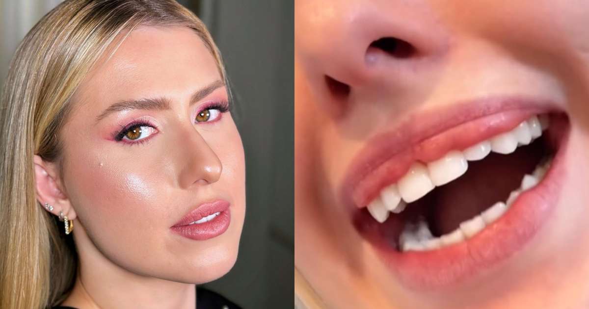 Influencer fica com '3 lábios' após preenchimento dar errado