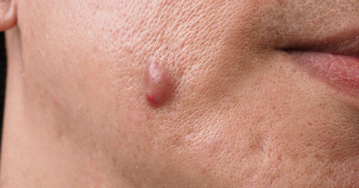 Especialistas respondem 11 dúvidas sobre furúnculo