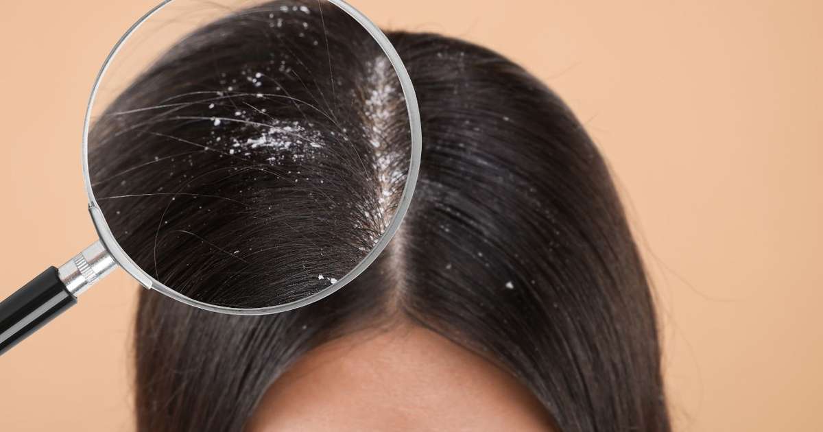 Caspa pode trazer consequências mais graves? Especialista explica