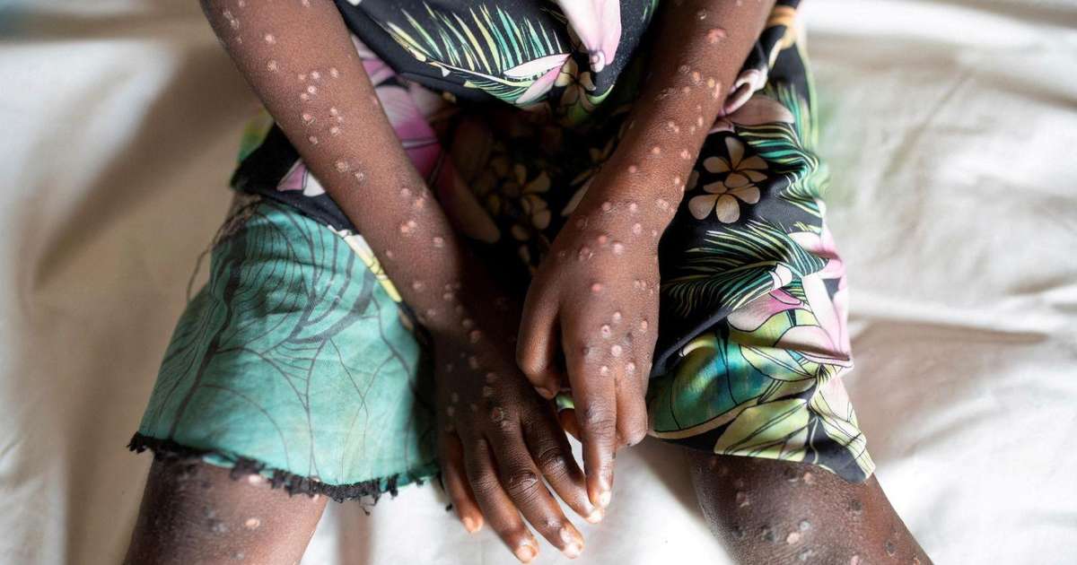 O que é mpox e como ela é transmitida?