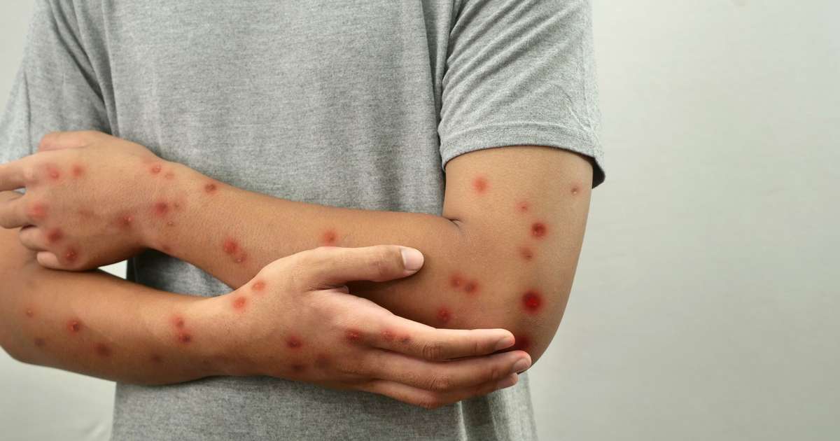 SP lidera casos de mpox no país: como identificar se uma lesão pode ser ...
